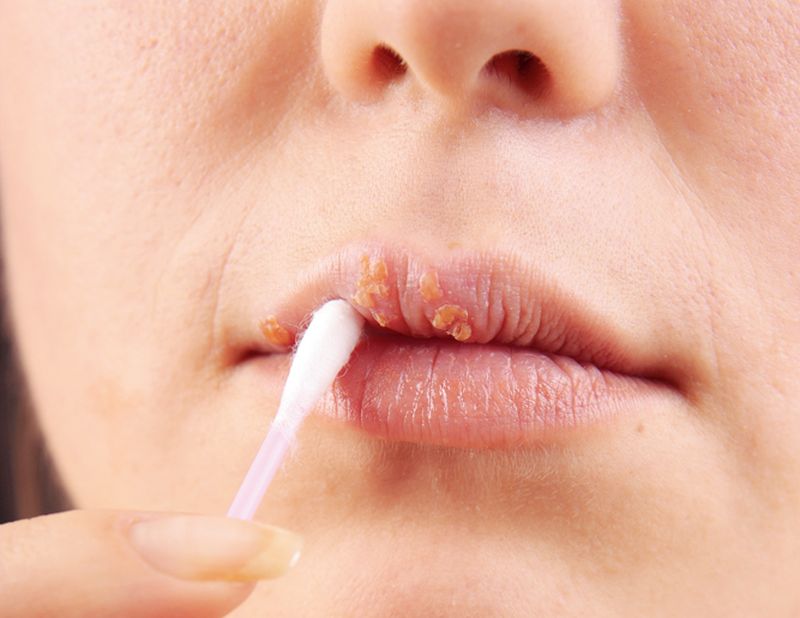 Vai herpes vīruss pasargā no saslimšanas ar Covid-19? Skaidro ...