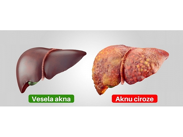 Aknu ciroze – dzīves ilgums | LA.LV