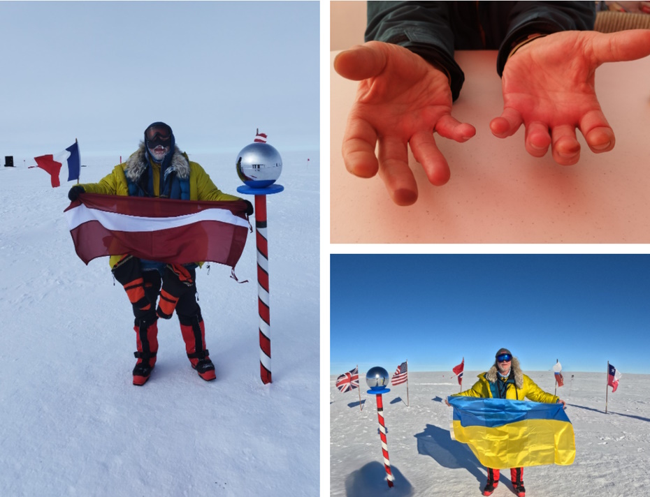 “Pirksti ir apsaluši. Ar laiku tie sadzīs…” Juris Ulmanis sasniedzis ...