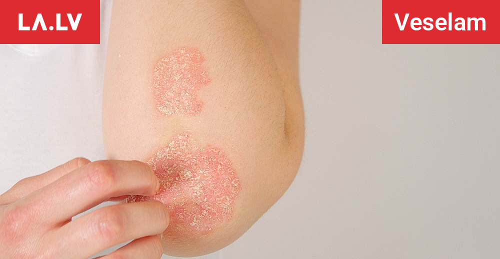 Psoriāzes pacientiem jāuzlabo efektīvu medikamentu pieejamība | Veselam.lv