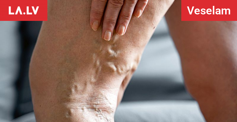 Nepatīkamas vēnas uz kājām? Ārste atklāj, ko darīt un kāpēc svarīgi ...